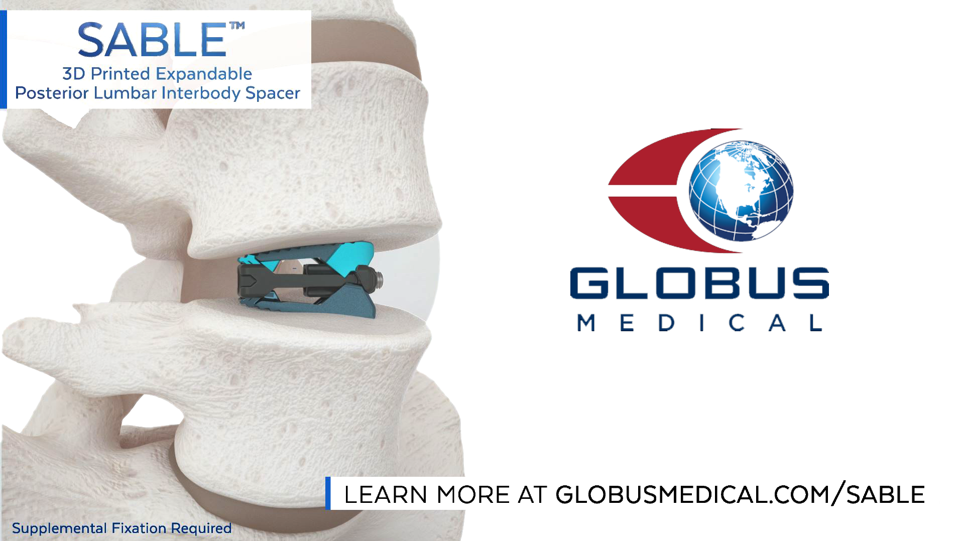 SABLE™ 3D Printed Expandable Implant - Justin Land Online